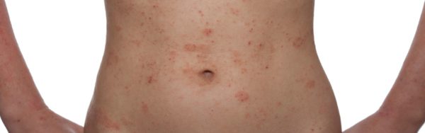 Tipi di dermatite: quali sono e come riconoscerli? - Centro Medico ...